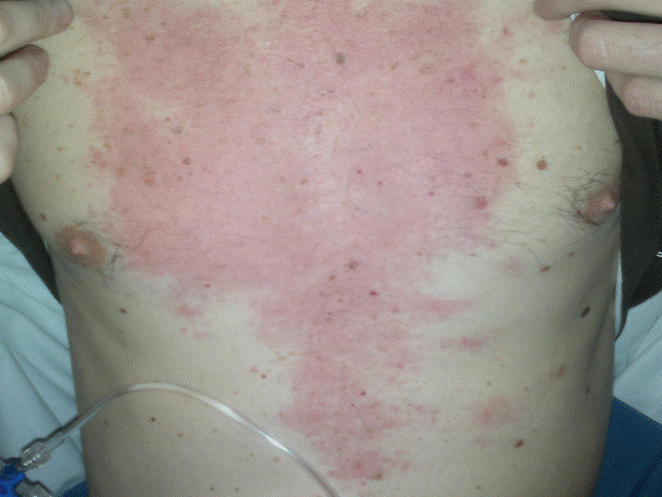 REACCIÓN CUTANEA DURANTE LA ADMINISTRACION DE RITUXIMAB ...