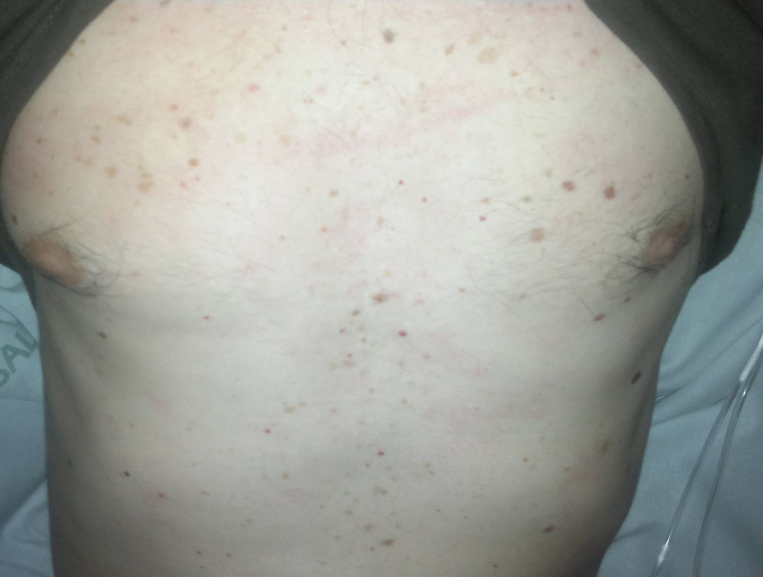 REACCIÓN CUTANEA DURANTE LA ADMINISTRACION DE RITUXIMAB ...